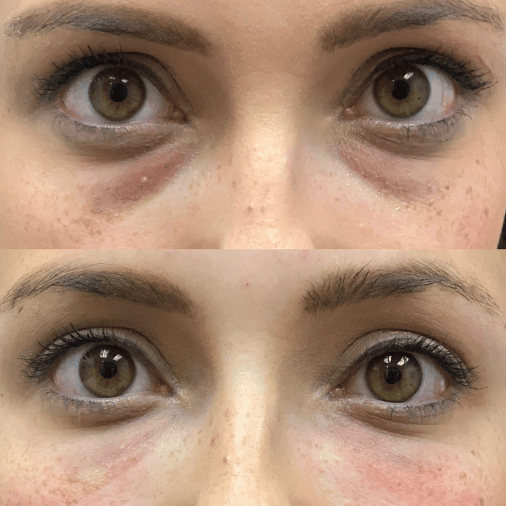 Martins Treatments Prp Under Eye Dark Circle Repair
